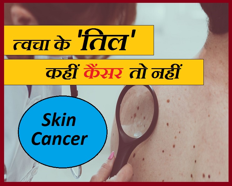 त्वचा पर तेजी से बढ़ रहे हैं तिल? तो यह हो सकता है कैंसर का संकेत ...