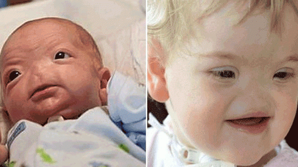 மூக்கே இல்லாமல் பிறந்த குழந்தை, மூன்றாவது வயதில் இறந்த பரிதாபம் - Three ...